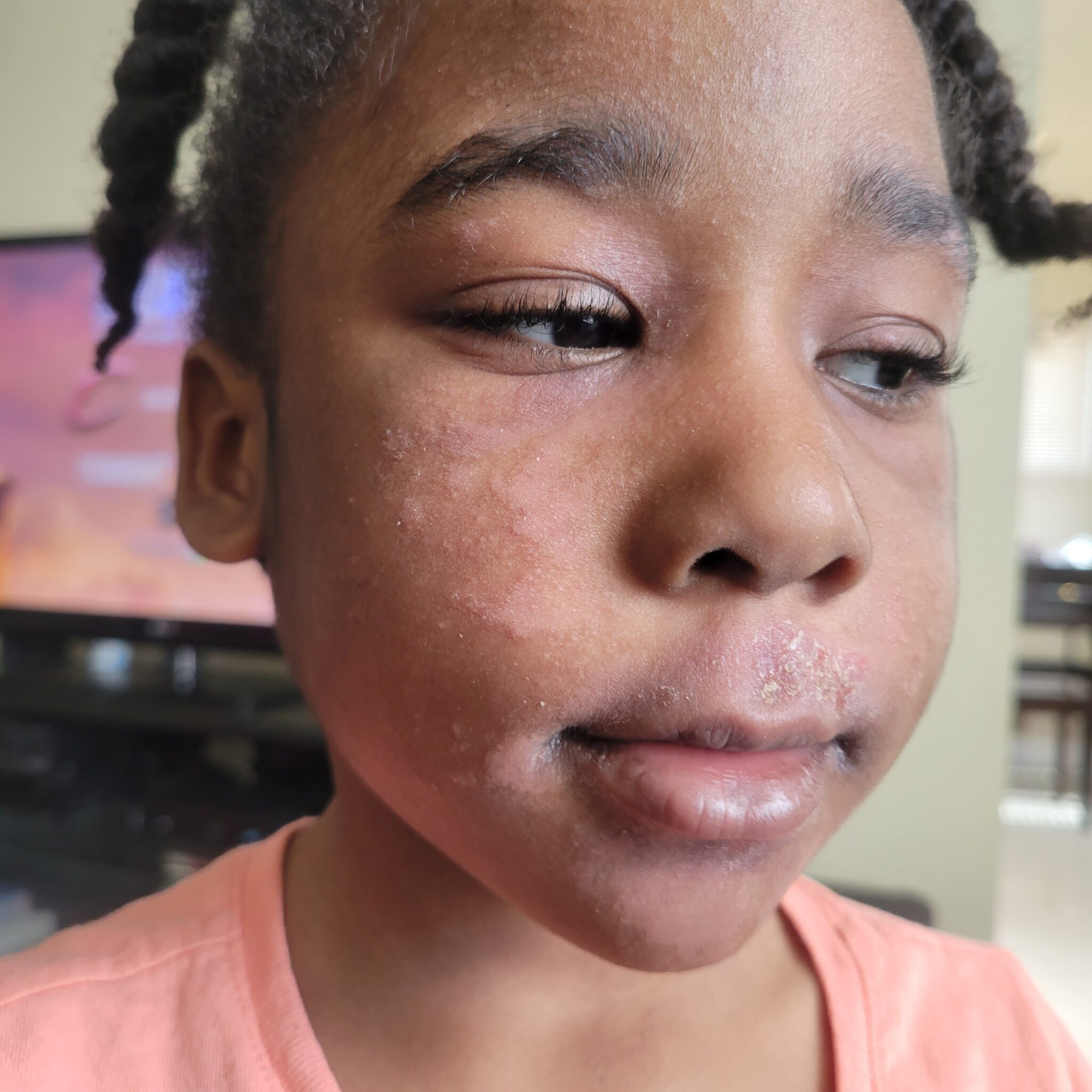 What we learned about Pediatric Urticaria (hives) and Food Allergies